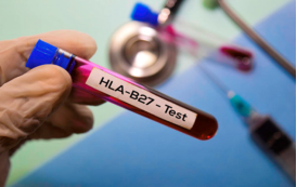 HLA-B27阳性等于强直性脊柱炎吗？-西安市第五医院